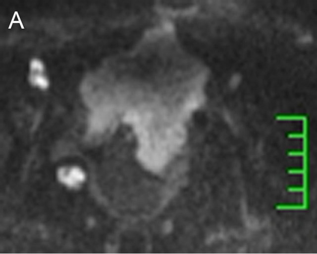Urinary Bladder Cancer: The Current and Potential Role of MR Imaging in ...