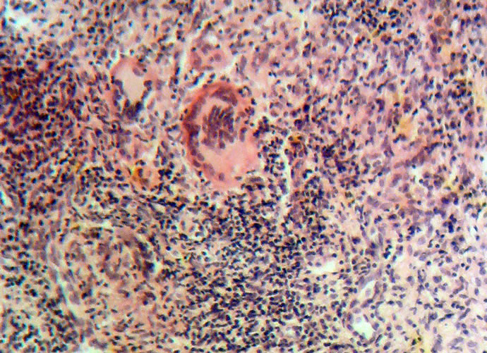 Cutaneous Crohn’s Disease and Anogenital Granulomatosis with Crohn’s ...