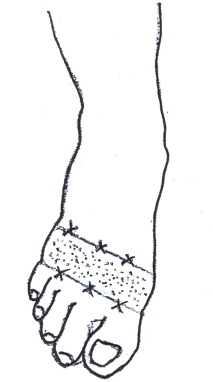 Treatment of Post Burn Scar Extended Deformity of the Toes IV Degree ...