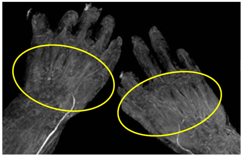 Arterial Imaging in Digital Gangrenes Associated with Scleroderma ...