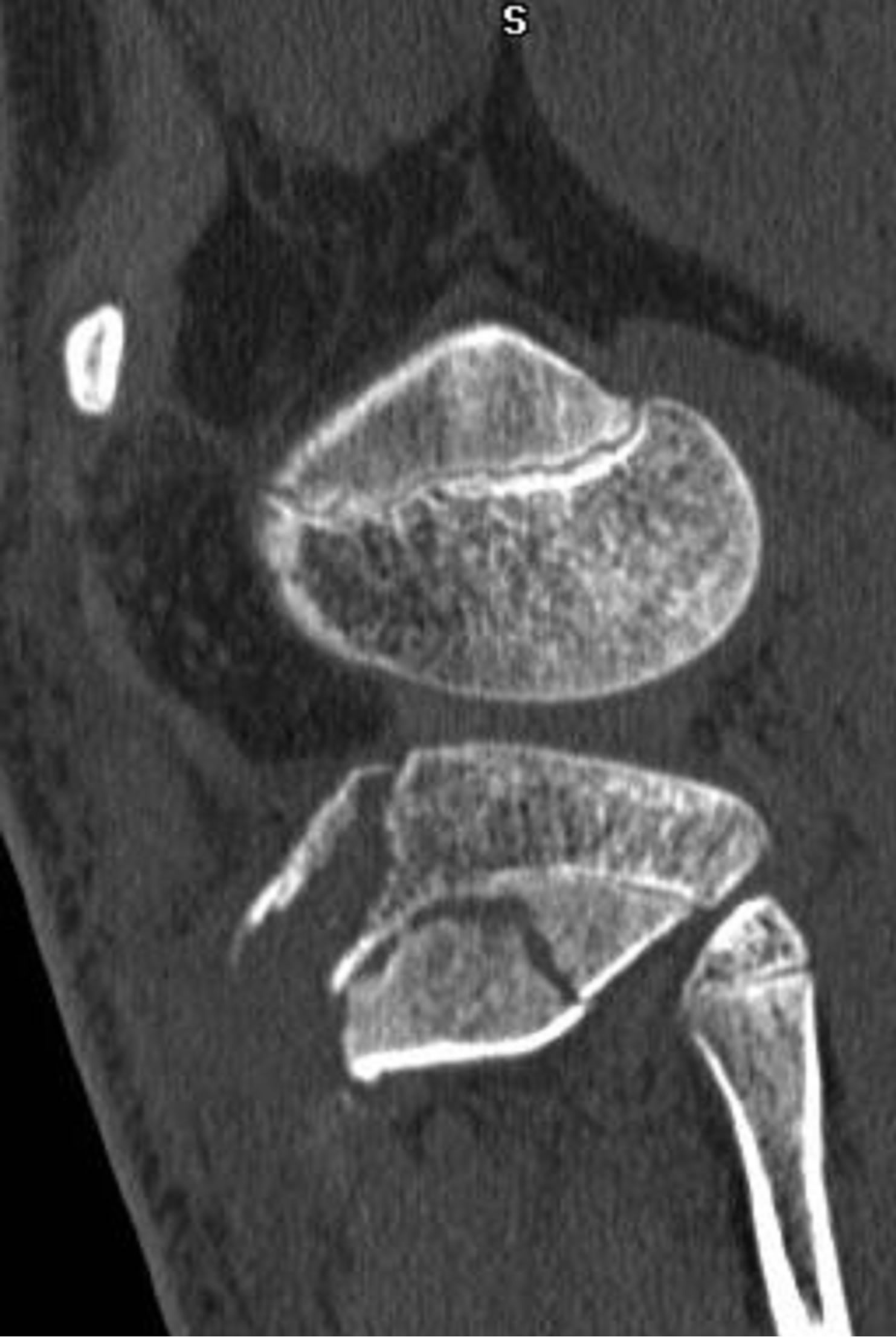 Imaging Review of Adolescent Tibial Tuberosity Fractures