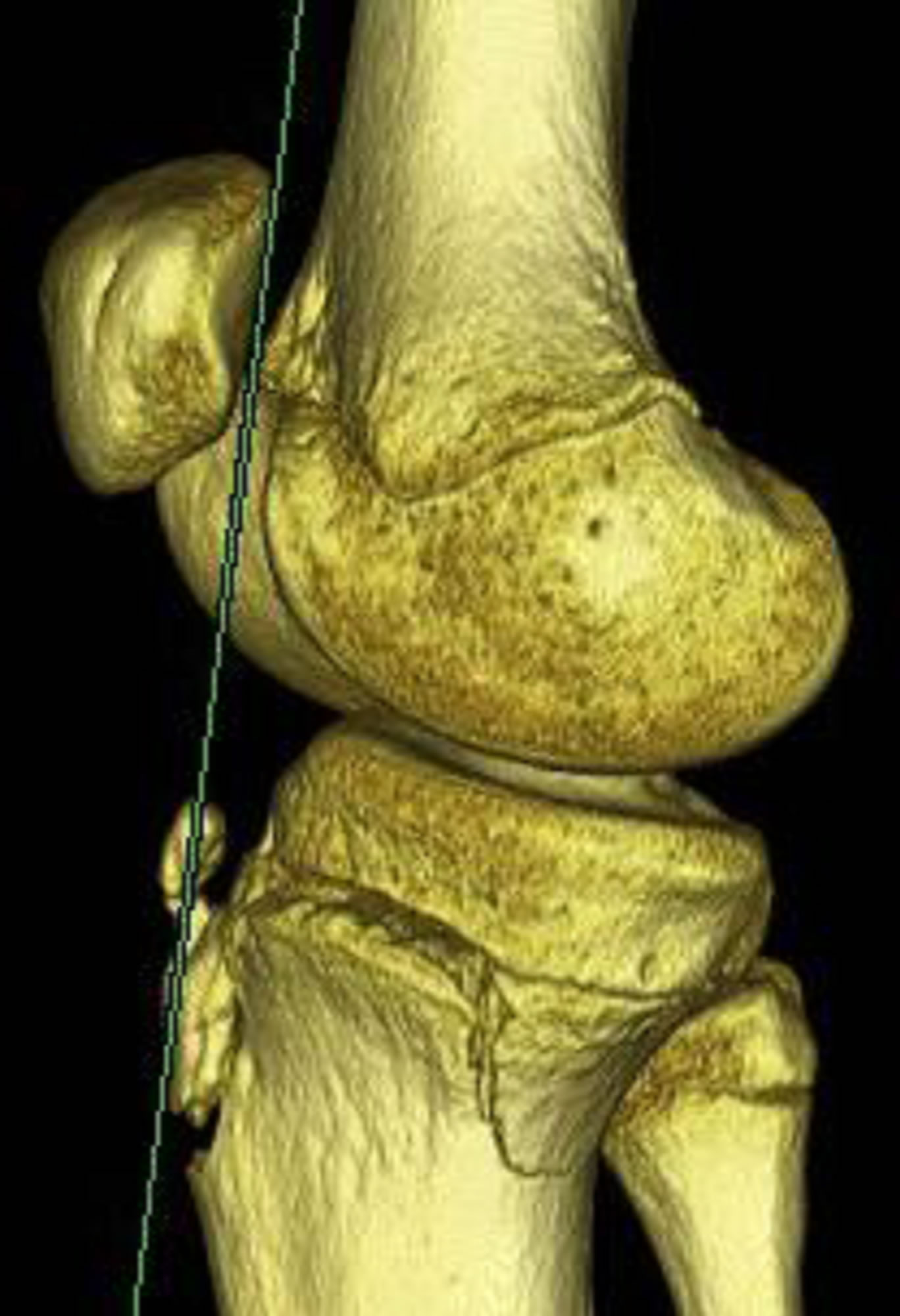 Imaging Review of Adolescent Tibial Tuberosity Fractures