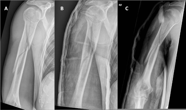 Nonunion of the humeral shaft successfully treated with teriparatide ...
