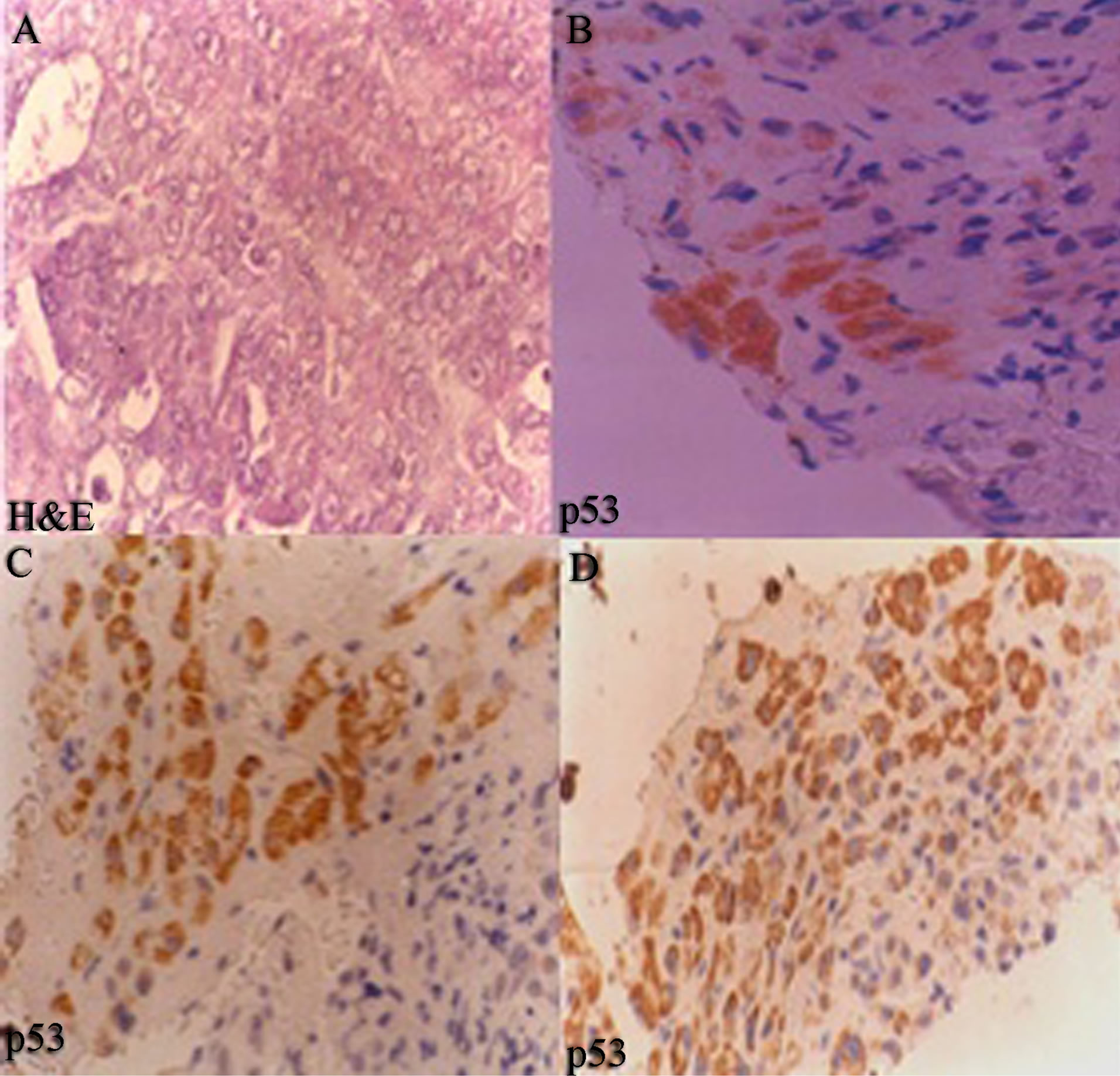 Novel strategy to diagnose and grade hepatocellular carcinoma