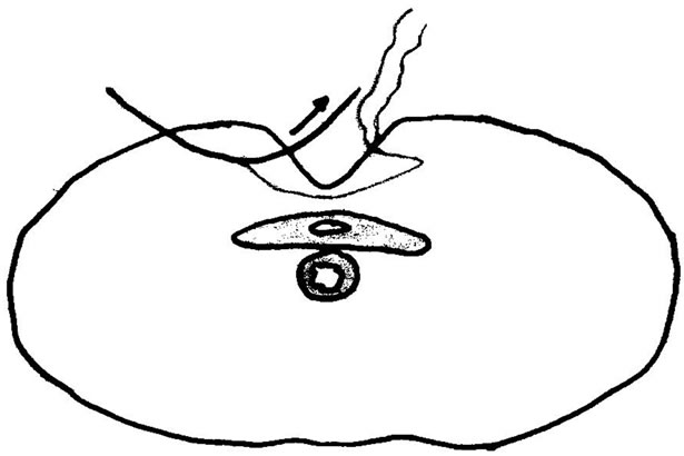 Excision and Partial Primary Closure of Wound for Pilonidal Disease