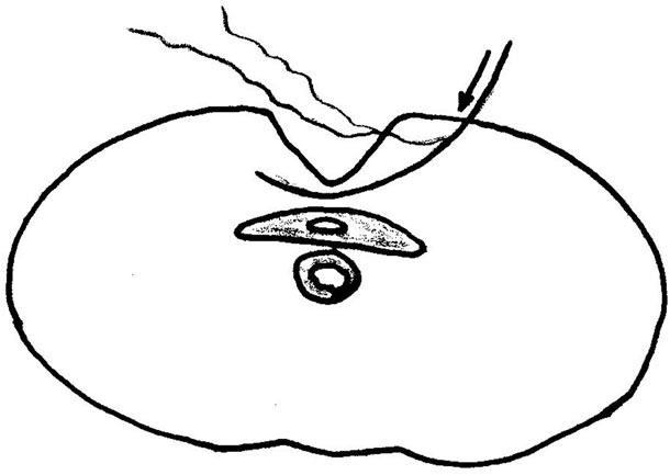 Excision and Partial Primary Closure of Wound for Pilonidal Disease