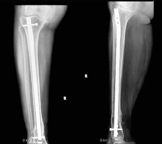 Distal Tibial Stress Fracture Secondary to Severe Osteoarthritis Knee