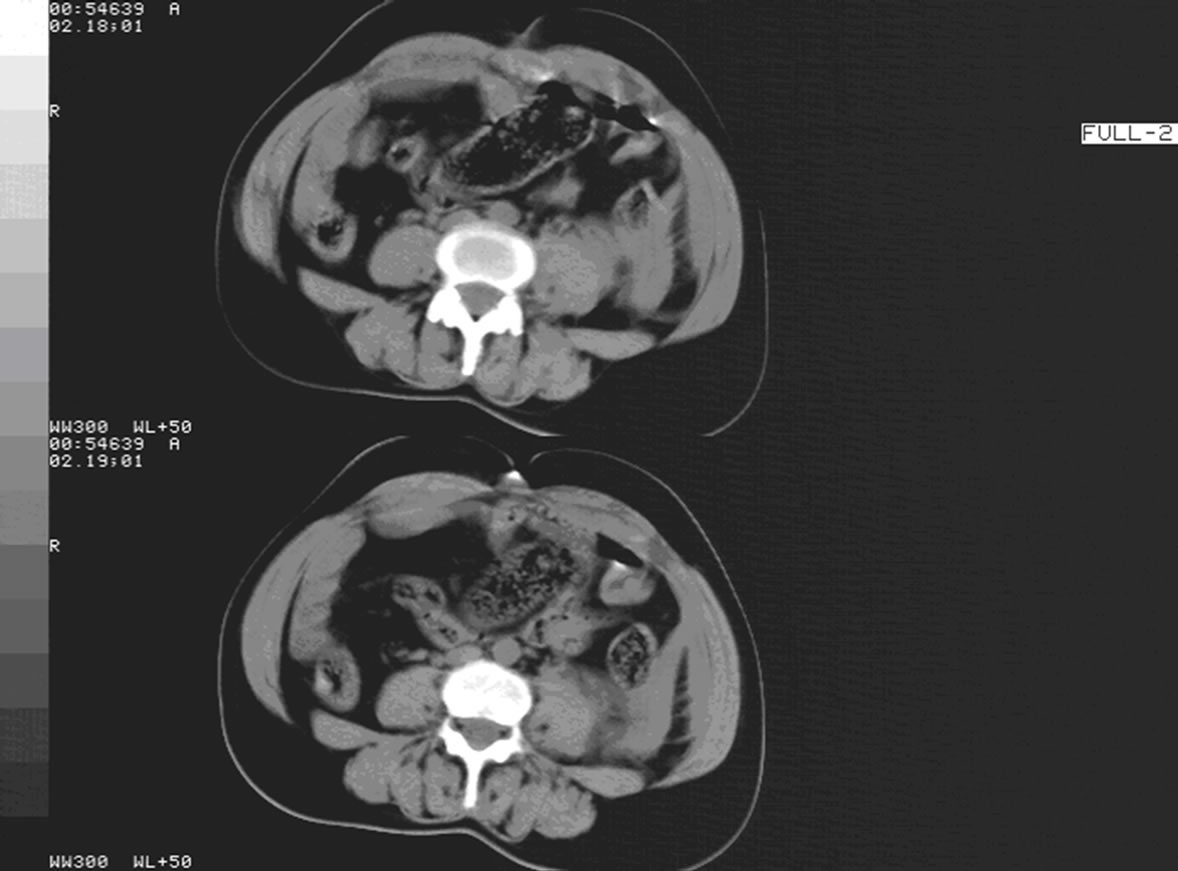 Spontaneous Rupture of the Left External Iliac Vein: Case Report