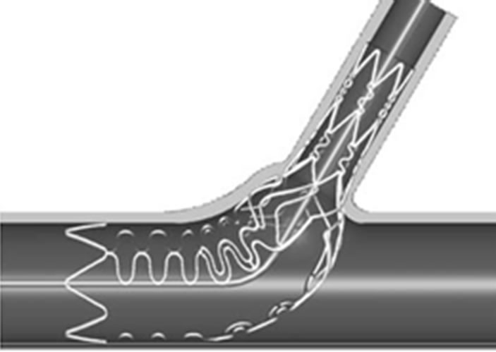 Coronary Stents Fracture: An Engineering Approach (Review)