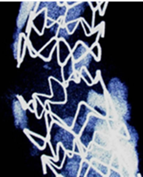 Coronary Stents Fracture: An Engineering Approach (Review)