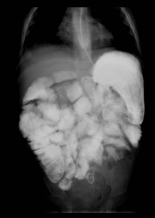 Late Presentation of a Congenital Intrinsic Duodenal Obstruction in a ...