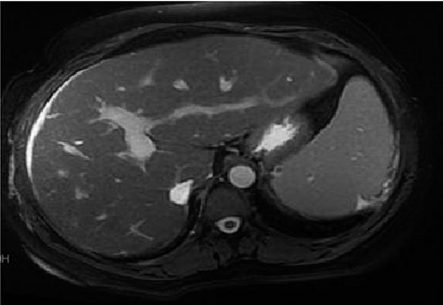 Cryptogenic liver cirrhosis diagnosed in pregnancy and khat consumption