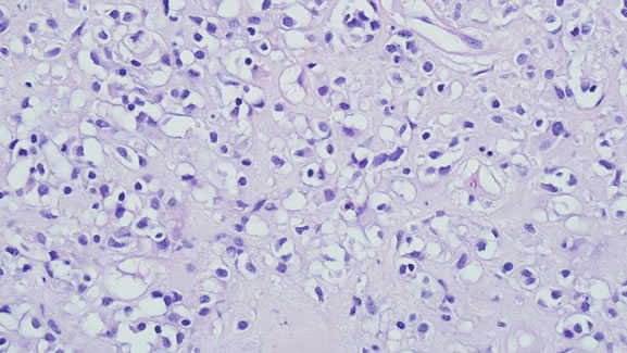 Gastrointestinal Stromal Tumor (GIST) with Chondroid-Myxoid-Chordoid ...