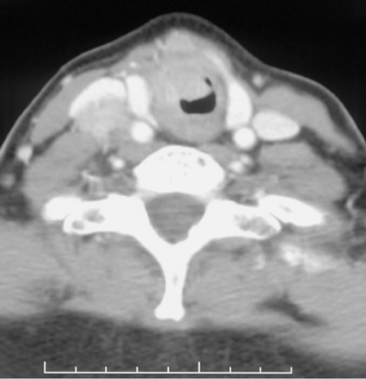Long Term Survival in a Patient with Anaplastic Thyroid Carcinoma ...
