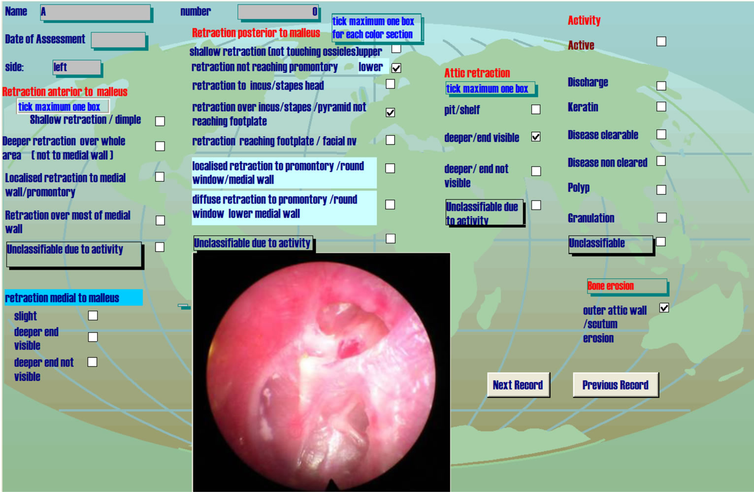 A Working Classification of Retraction for the Whole Tympanic Membrane