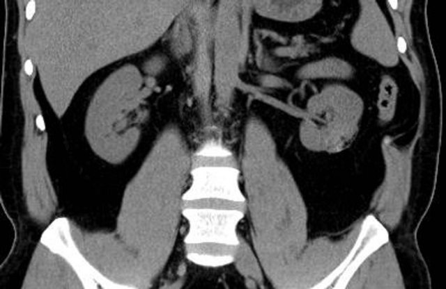CT Appearance Following Partial Nephrectomy for Renal Cell Carcinoma ...