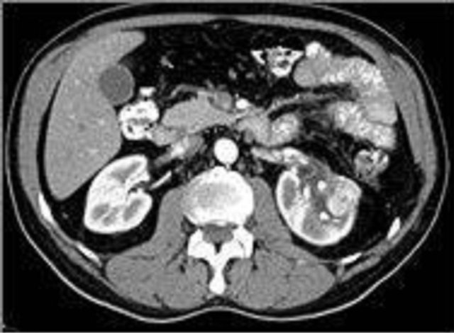CT Appearance Following Partial Nephrectomy for Renal Cell Carcinoma ...