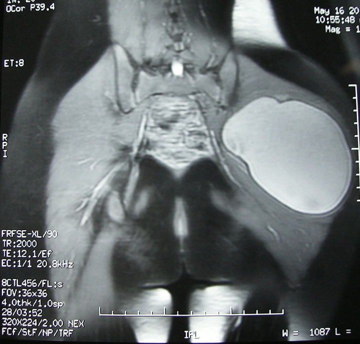 Primary hydatid cyst as a cause of pseudotumor of the buttock