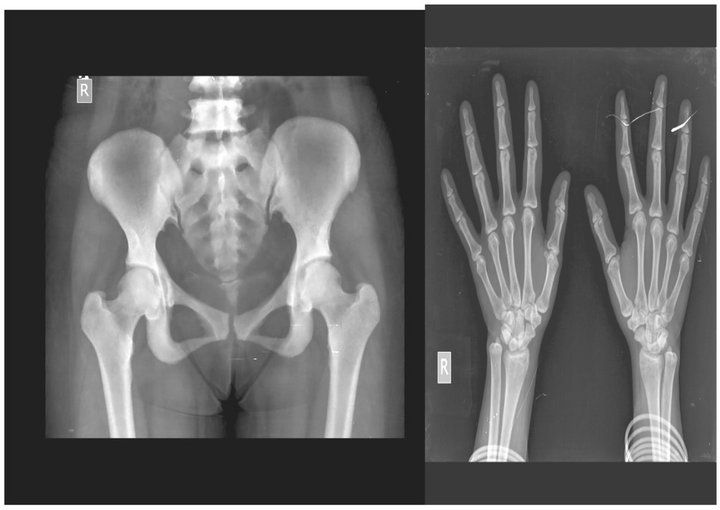 Renal Osteodystrophy in Mullerian, Renal, Cervicothoracic Somite ...
