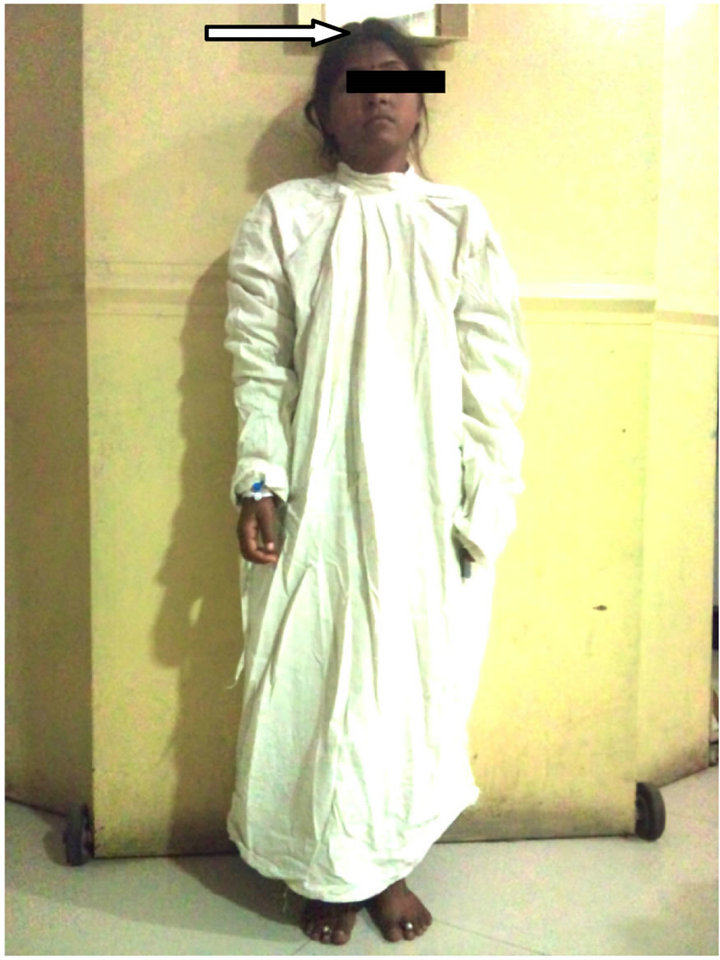 Renal Osteodystrophy in Mullerian, Renal, Cervicothoracic Somite ...