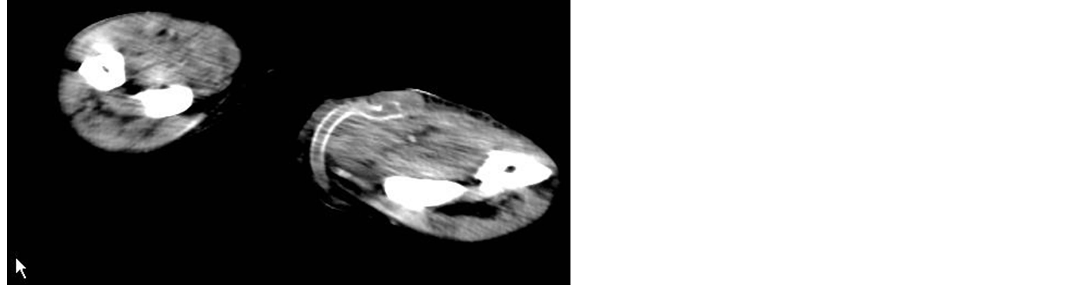 The Use of Positron Emission Tomography in the Diagnosis of Prosthetic ...