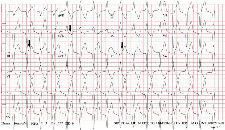 Spontaneous coronary dissection presenting with reperfusion arrhythmia ...