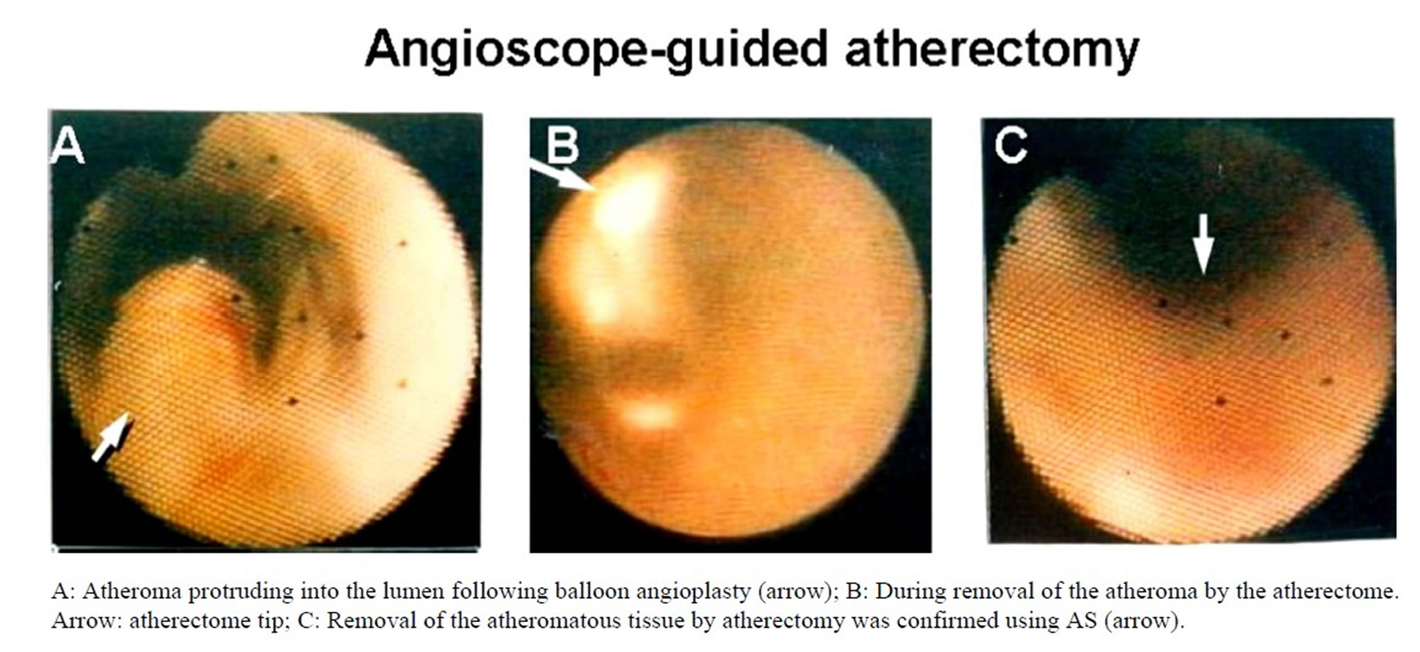 Advances in Angioscopic Imaging of Vascular Disease