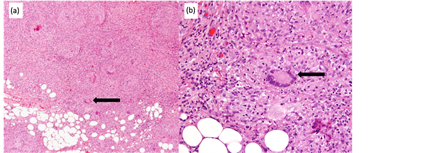 Peritoneal Tuberculosis: Looking beyond the Typical Pathology