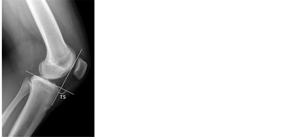 Relationship between Coronal Alignment and Posterior Tibial Slope in ...