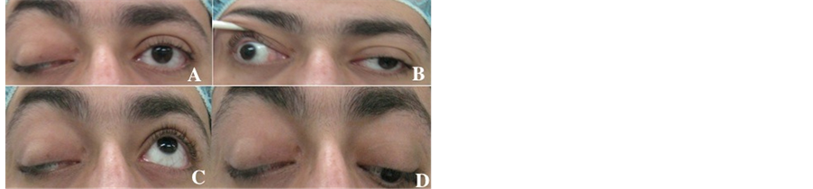 Surgical Correction for Paralytic Strabismus Using T-Plate Anchor