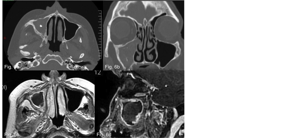 Silent Sinus Syndrome: Clinical Findings and Differential Diagnosis