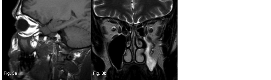 Silent Sinus Syndrome: Clinical Findings and Differential Diagnosis