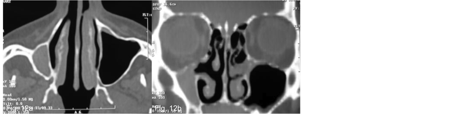 Silent Sinus Syndrome: Clinical Findings and Differential Diagnosis