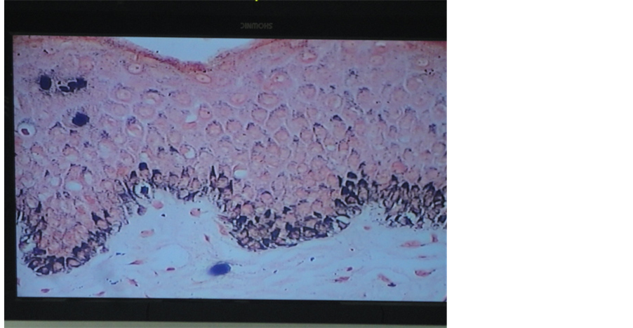 Frictional Melanosis of Rubbing Thighs in Iraqi Patients