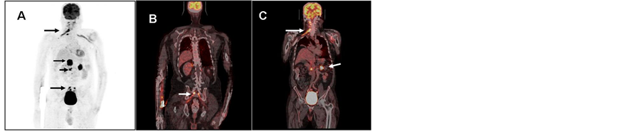 Neurolymphomatosis: A Rare Cause of Multiple Mononeuropathy