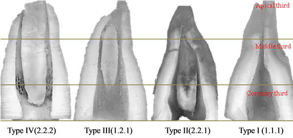 Correlation between Anatomy and Root Canal Topography of First ...