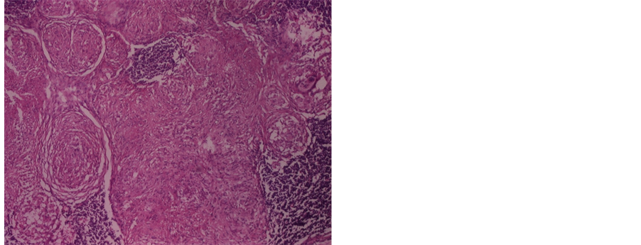 Multiple Calcifying Epitheliomas of Malherbe’s of Axilla: A Case Report ...
