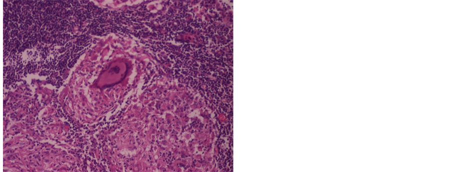 Multiple Calcifying Epitheliomas of Malherbe’s of Axilla: A Case Report ...