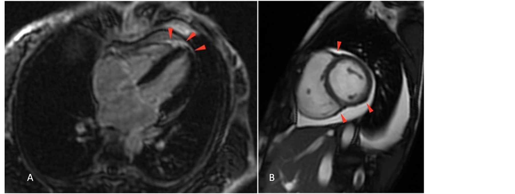 Myopericarditis: Physiopathological Consideration and Image Diagnosis—A ...
