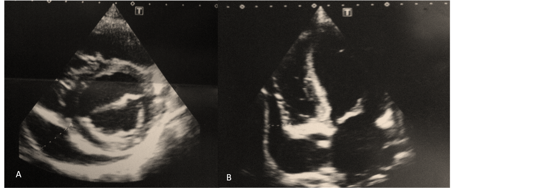 Myopericarditis: Physiopathological Consideration and Image Diagnosis—A ...
