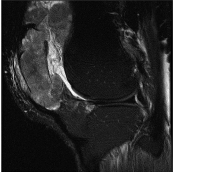 Metastatic Rectal Adenocarcinoma of the Hip and Knee Joints: A Case Series