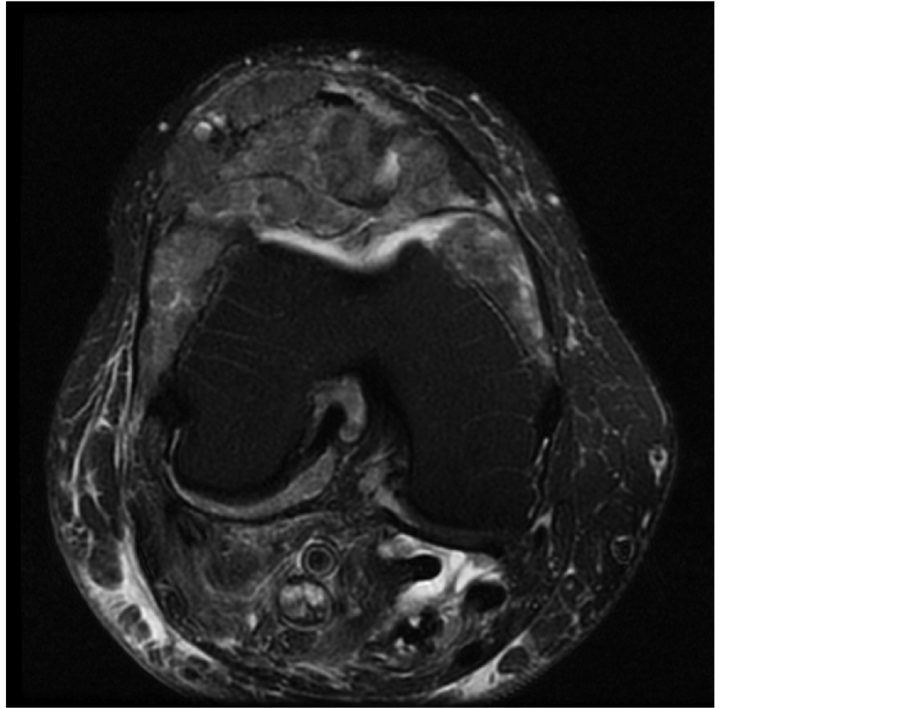 Metastatic Rectal Adenocarcinoma of the Hip and Knee Joints: A Case Series