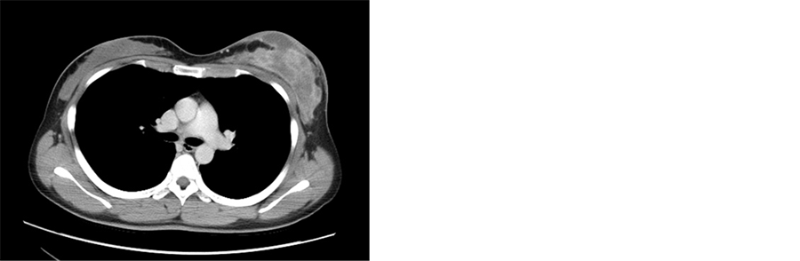 Granulomatous Mastitis with Erythema Nodosum That Responded to Low-Dose ...