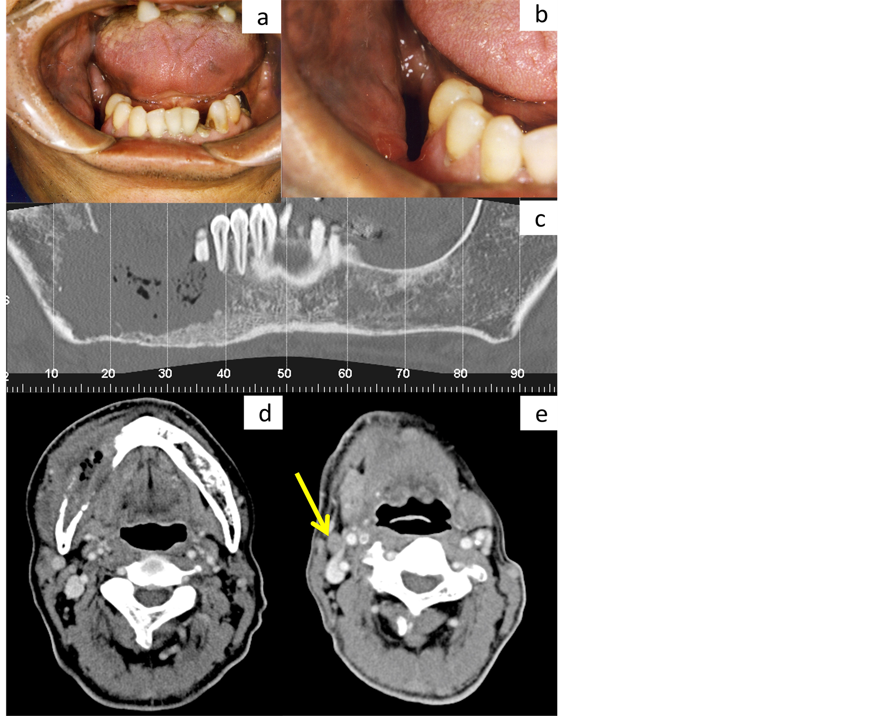 A Case of Oral Squamous Cell Carcinoma with Scattered Metastases