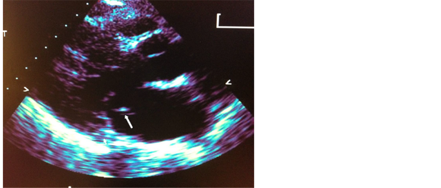 Rheumatoid Nodule Causing Perforation of Anterior Mitral Leaflet and ...