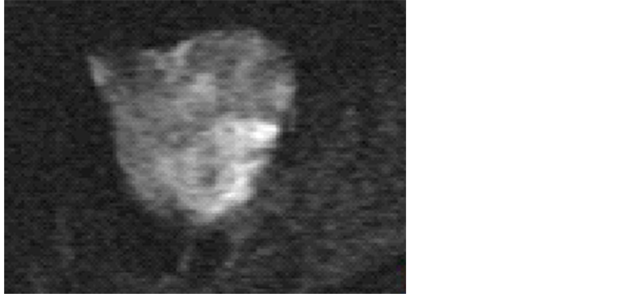 Proliferative Brenner Tumor with Borderline Mucinous Cystadenocarcinoma ...