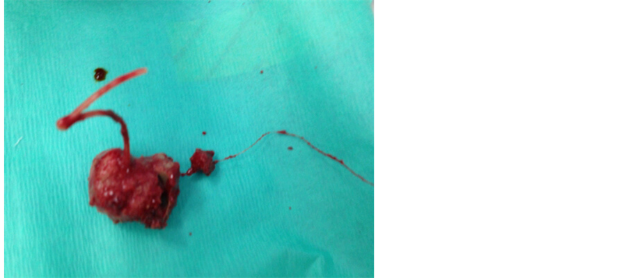 A 20-Year-Old Contraceptive Device Transformed into a Calcified Mass