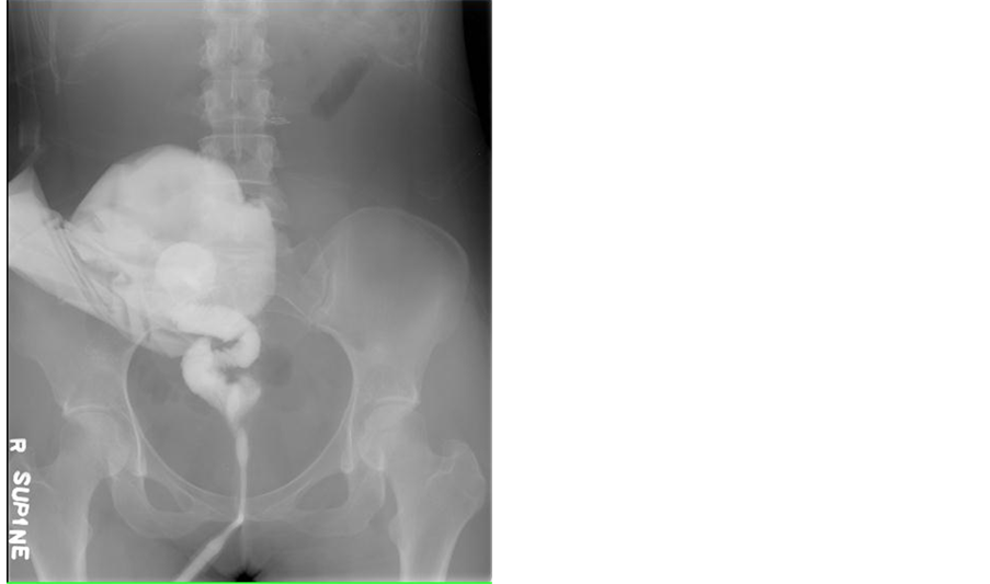 Long-axis rotational volvulus in an ileal J-pouch anal anastomosis: A ...