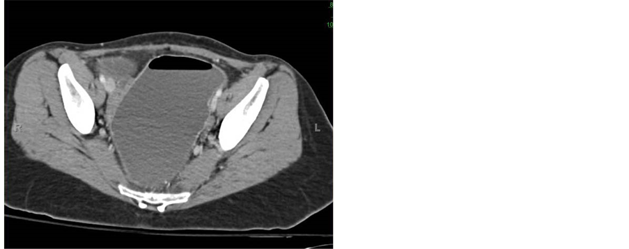 Long-axis rotational volvulus in an ileal J-pouch anal anastomosis: A ...