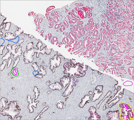 Automated Detection and Quantification of Prostate Cancer in Needle ...